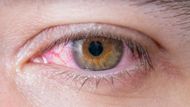 Gejala dan Pengobatan Infeksi Herpes pada Kornea | SEHAT.link